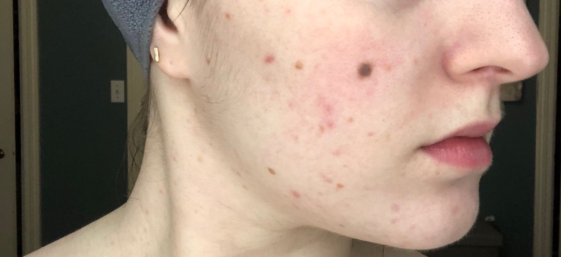 My Tretinoin Journey: How I Finally Cured My Hormonal Acne