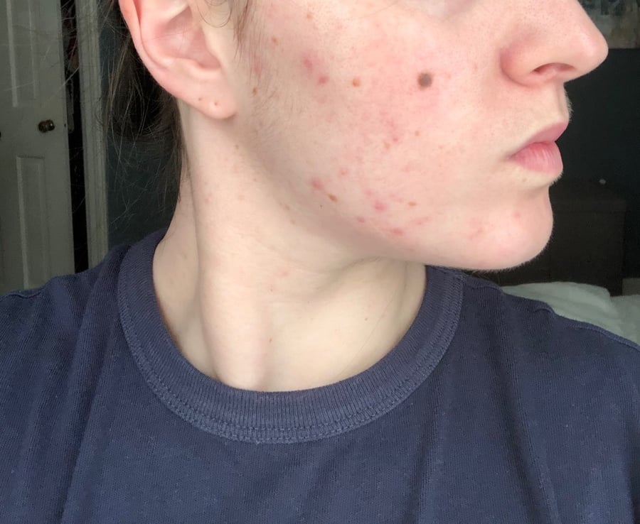 My Tretinoin Journey: How I Finally Cured My Hormonal Acne